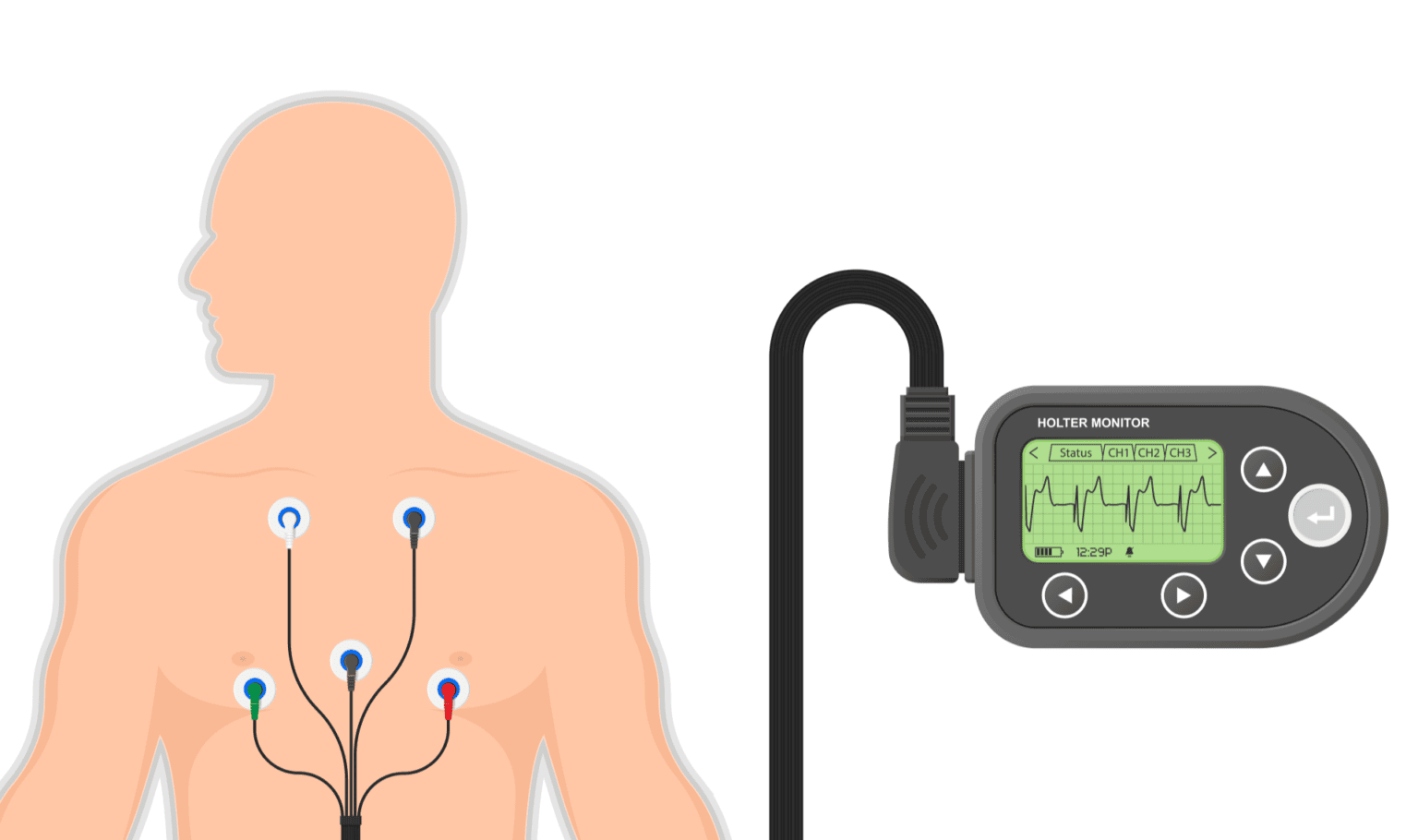 Afib Tests – PCNA Atrial Fibrillation