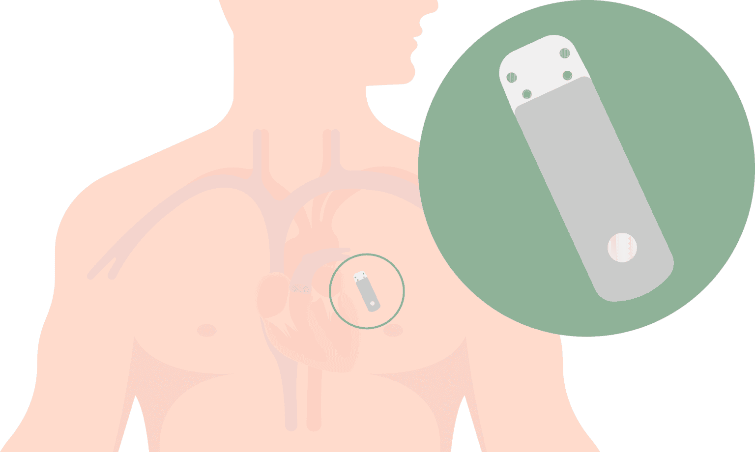 Treatments and Strategies – PCNA Atrial Fibrillation