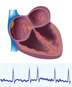 ¿Qué es la fibrilación auricular? – PCNA Atrial Fibrillation